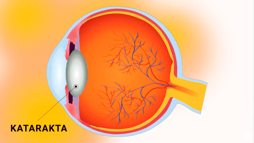 Operacija katarakte (mrene) po odličnoj ceni - Apolon Klinika